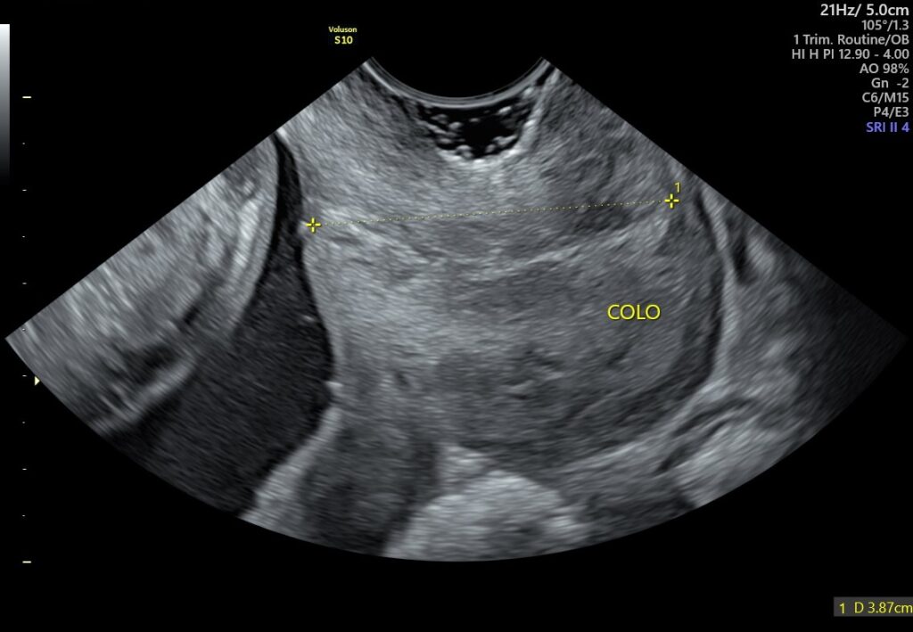 Ultrassom transvaginal para medida de colo uterino ...